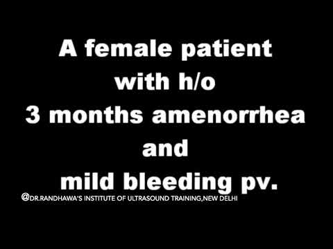 PARTIAL MOLE WITH LIVE FETUS 12 WEEKS (SAD FETUS SYNDROME) . BILATERAL THECA LUTEIN CYSTS