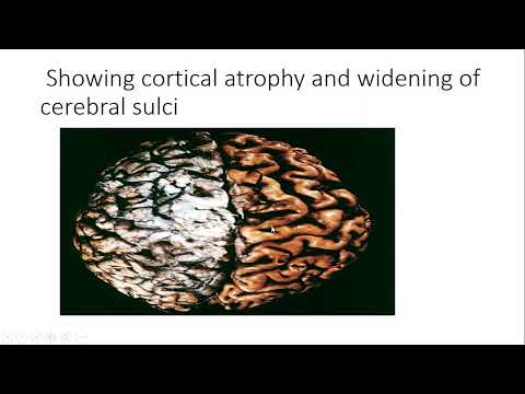 Neurodegenerative Diseases of the Cerebral Cortex | Brain Disorders Explained