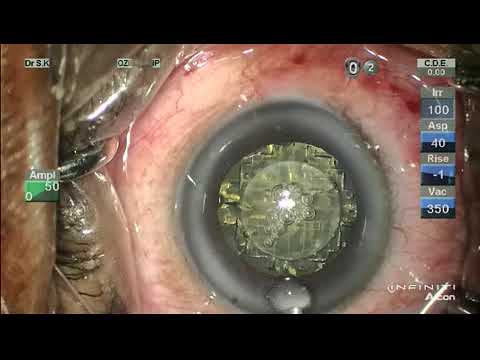 LRCS PHACO CATALYS - The Eye Foundation