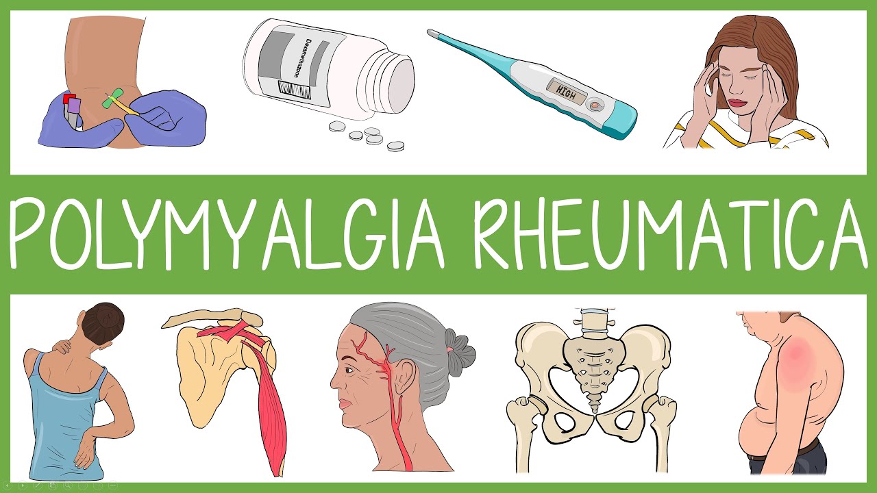 Polymyalgia Rheumatica Visually Explained