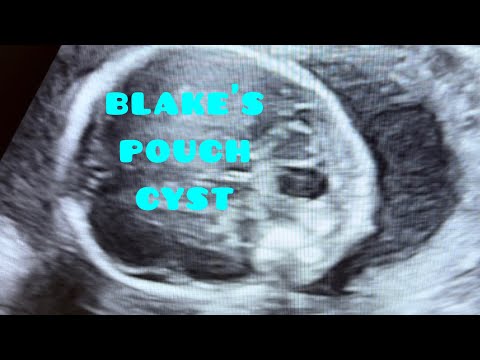 Ultrasound of Blake’s pouch cyst in 21 weeks fetus