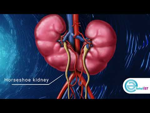 Horseshoe kidney.
