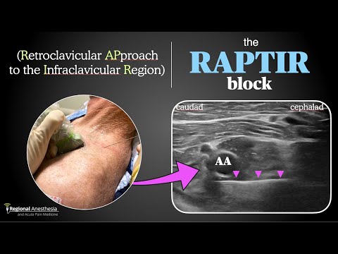 RAPTIR block (Retroclavicular Approach to the Infraclavicular Region)