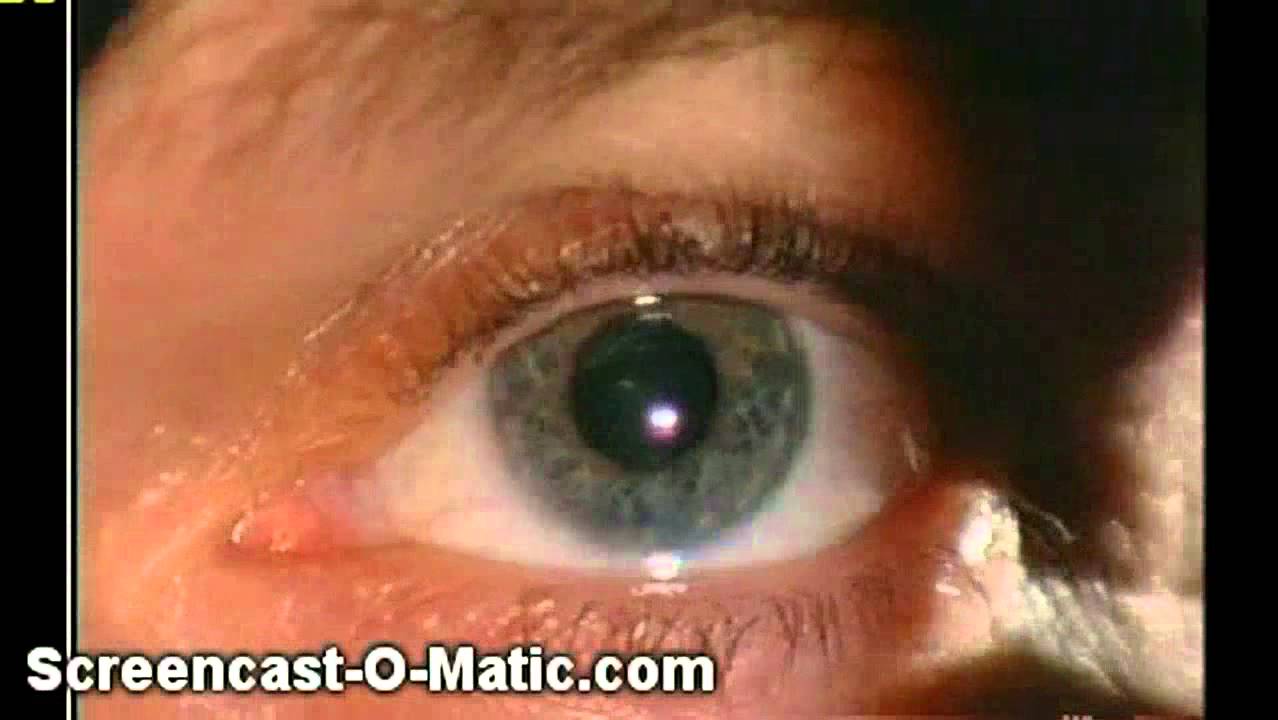 Blindsight - Seeing Without Awareness