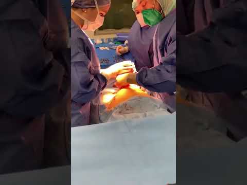 Kopfgeburt beim Kaiserschnitt cesarean