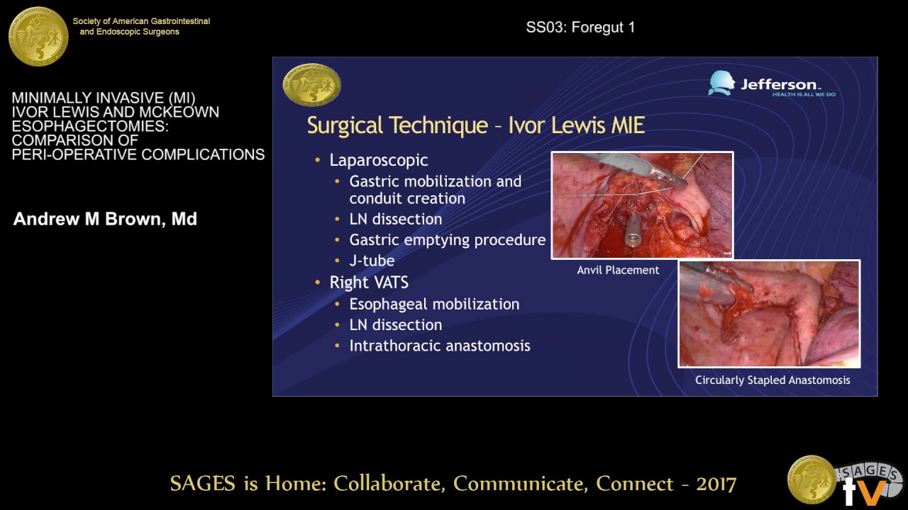 Minimally invasive Ivor Lewis & McKeown esophagectomies: Comparison of peri-operative complication