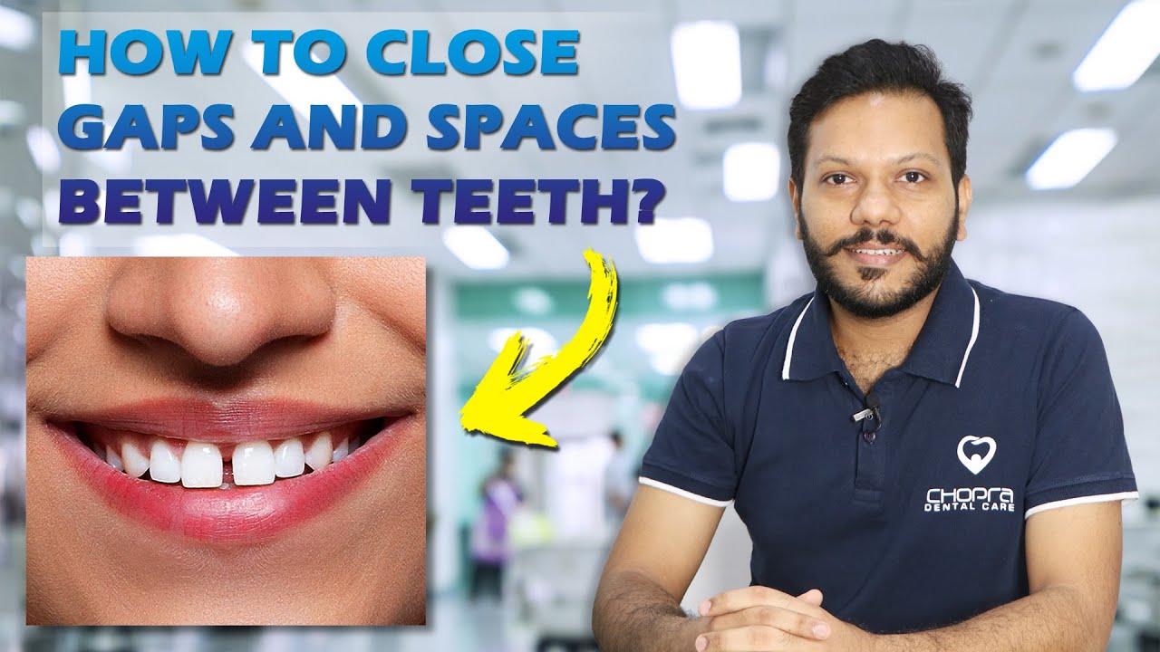 How To Close Gaps And Spaces Between Teeth? | Dr. Pankaj Chopra