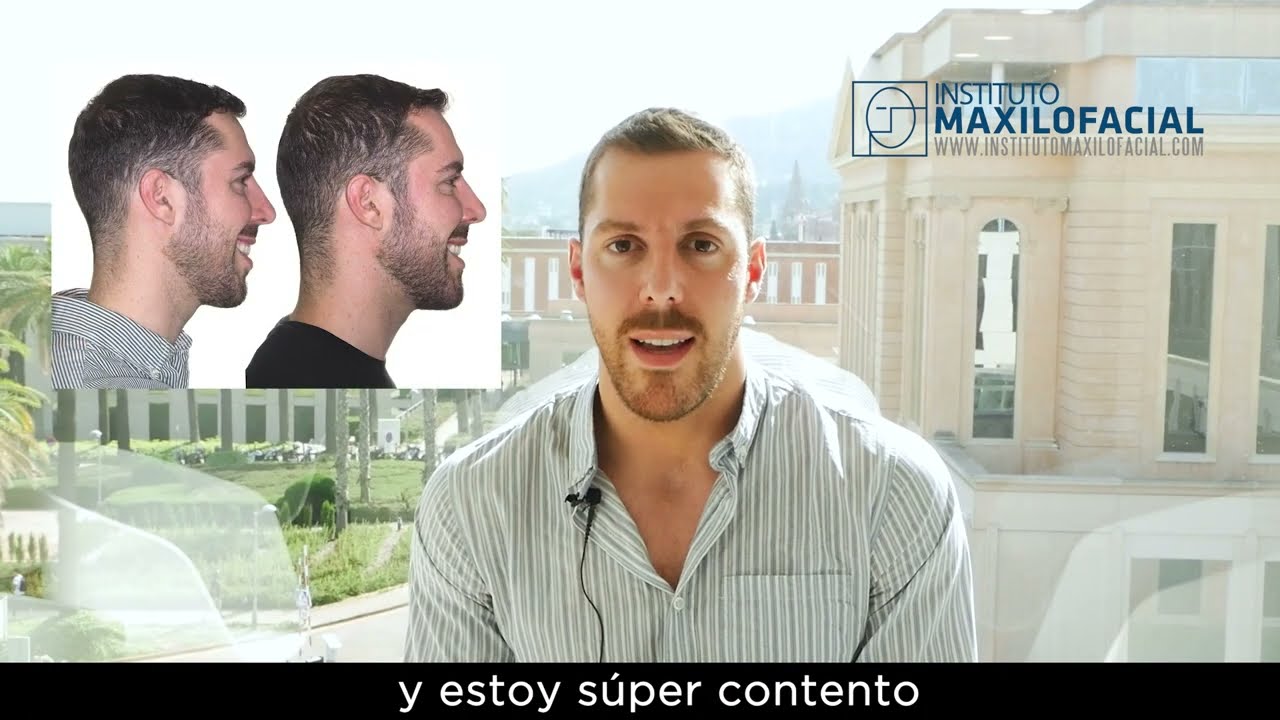 Mario- Mentoplastia de avance