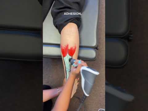 What is the fastest way to heal the Achilles tendon? Shockwave Therapy!