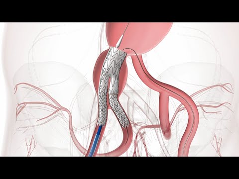 ANIMATION - GORE® EXCLUDER® ILIAC BRANCH ENDOPROSTHESIS