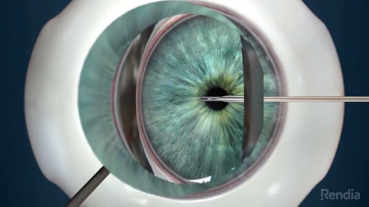 iStent Inject® animated video