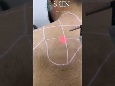 Laser Hair Removal for Men