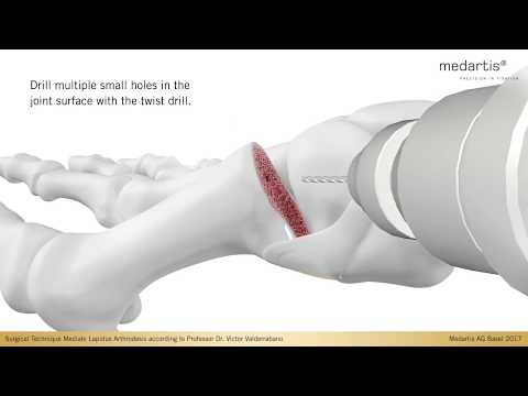 APTUS Foot Hallux System 2.8 Lapidus Arthrodese TMT-1 Medial Fusion