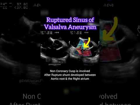 Ruptured Sinus of Valsalva Aneurysm #echocardiography #echocardiogram #cardiology #lcx