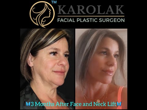 Facelift and Neck Lift by Dr Karolak - Danielle's Journey - Video guide to Facelifts and Recovery