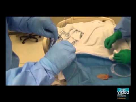 Percutaneous Endoscopic Gastrostomy /pull method/ and Jejunal Extension Tube Placement