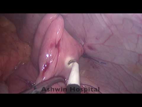 Laparoscopic Feeding Jejunostomy