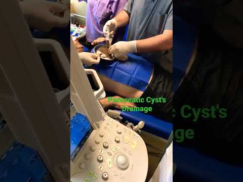#Pancreatic Cyst Drainage