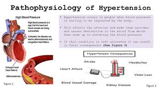 hypertension ppt