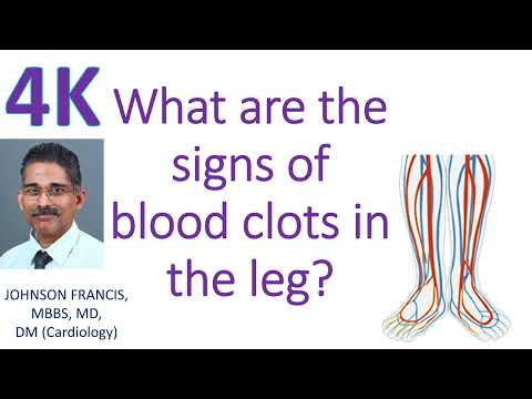 What are the signs of blood clots in the leg?