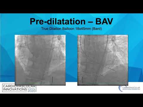 Palma Dallan_Subocclusive Iliac Access Treated by Intravascular Lithotripsy_Structural