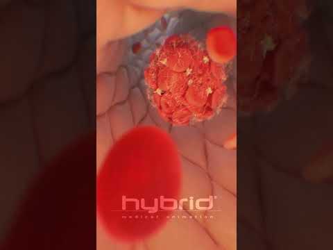 Venous thromboembolism | Deep vein thrombosis (DVT)  | #thrombosis  #medicalanimation #bloodclot
