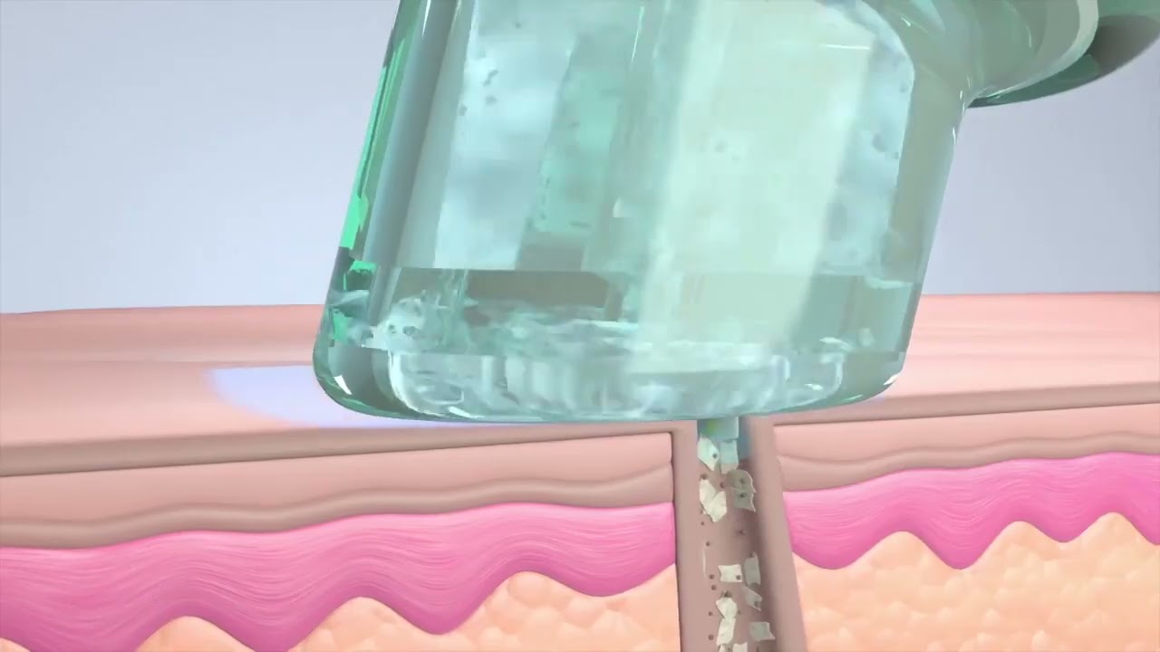 HydraFacial MD - How it works