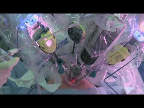 Scarless Gallbladder Removal