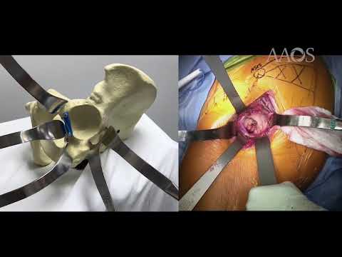 OVT: "Anatomic Navigation" for Acetabular Component Positioning in Direct Anterior Approach to THA