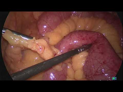 Laparoscopic lysis of adhesion for SBO