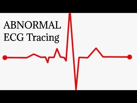 What does abnormal ECG mean on an ECG|How do you know if your ECG is abnormal| abnormal ECG tracing|