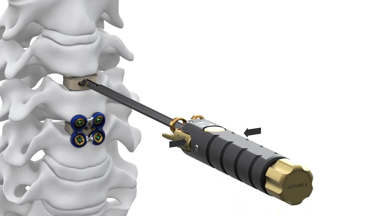 Sapphire X Segmental Plating System Animation