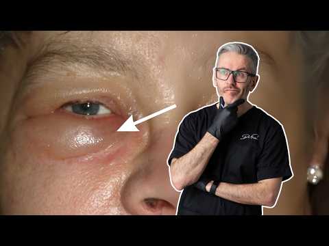 Puffy Eyes After Botox? How to Diagnose & Treat Periorbital Edema.