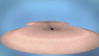 Travanti Medical IontoPatch 80 mA min Electronic Transdermal ...