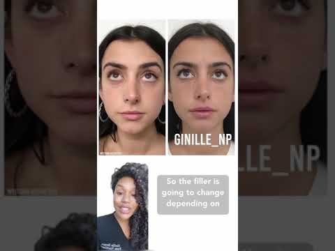 What #filler will you use to treat my #undereyes ? Under eye injections before and after