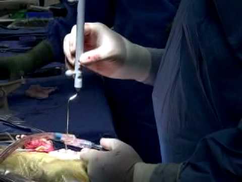 Brain Surgery: Cerebral AVM Surgery