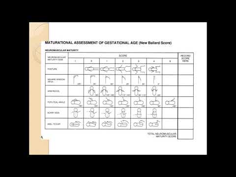 Ballard score pdf - Fill Out and Sign Printable PDF Template | SignNow