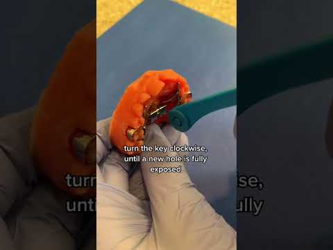 Turning an orthodontic expander #braces #orthodontic #crankthatsouljaboy #phase1orthodontics