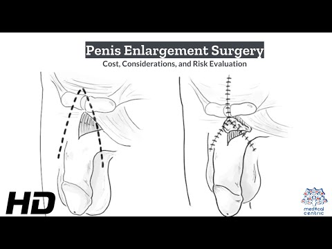 Is Penis Enlargement Surgery Worth the Risk? Pros and Cons