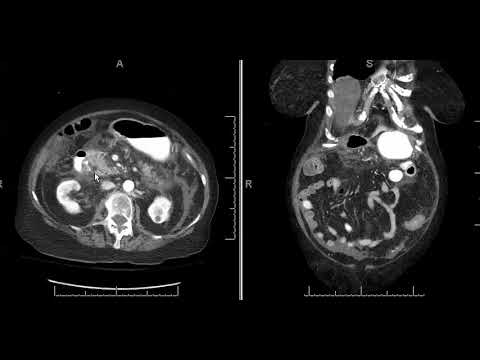 gallstone pancreatitis