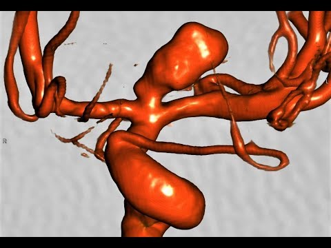 Left ICA BIFURCATION ANEURYSM COILING