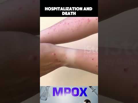 What Is Mpox? | How Does it Spread and Preventions | Monkeypox Outbreak | Monkeypox Symptoms #mpox