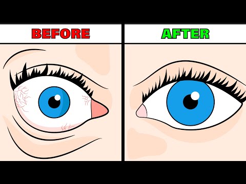 How to Reverse Thyroid Eye Disease Naturally (NO SURGERY!)