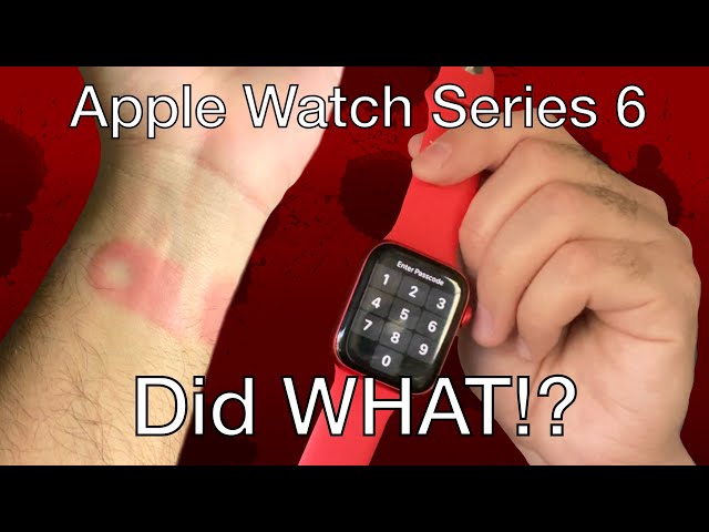 Apple lists three things you can do to avoid painful welts on your ...