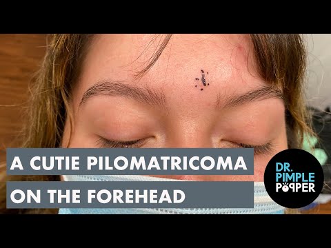 Dr. Pimple Popper Plucks a 'Pebble' From a Patient's Forehead