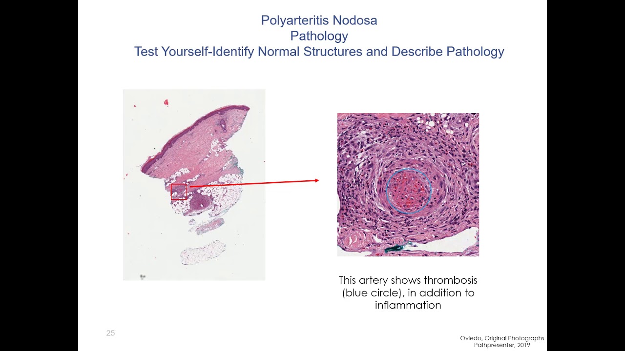 LG30 Vasculitis PPT Video