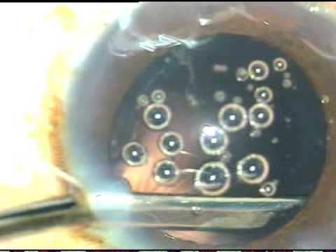 Phaco of a cataract with Grade 3 plus Nuclear Sclerosis - P Mohanta, NEH