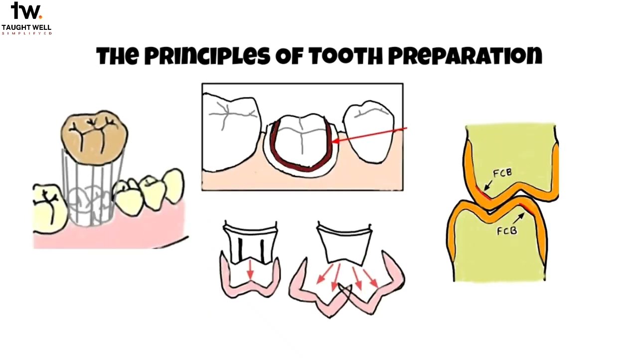 Principles of tooth preparation
