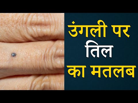 उंगली पर तिल का मतलब | Mole on finger means