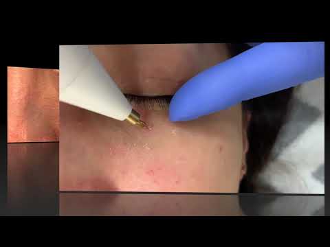 Syringomas removal